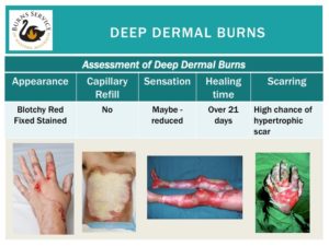 Deep dermal burns - Charlie's ED