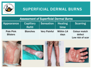 Superficial dernal burns - Charlie's ED