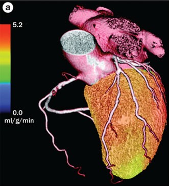 CME 17/03/16 - Noninvasive Cardiac Testing for ACS - Charlie's ED