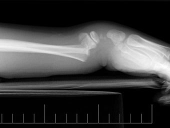 distal radial fracture Archives - Charlie's ED